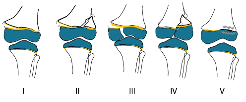 Salter Harris fracture and its types